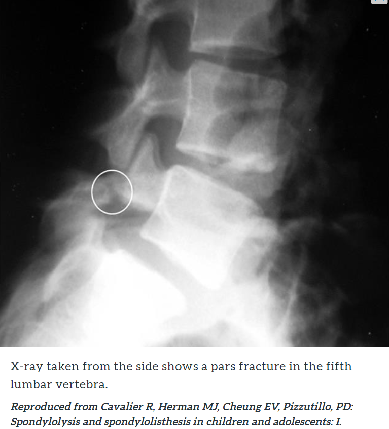 Why Skinny Thin People Can Still Have Low Back Pain - Ask Dr. P - The ...